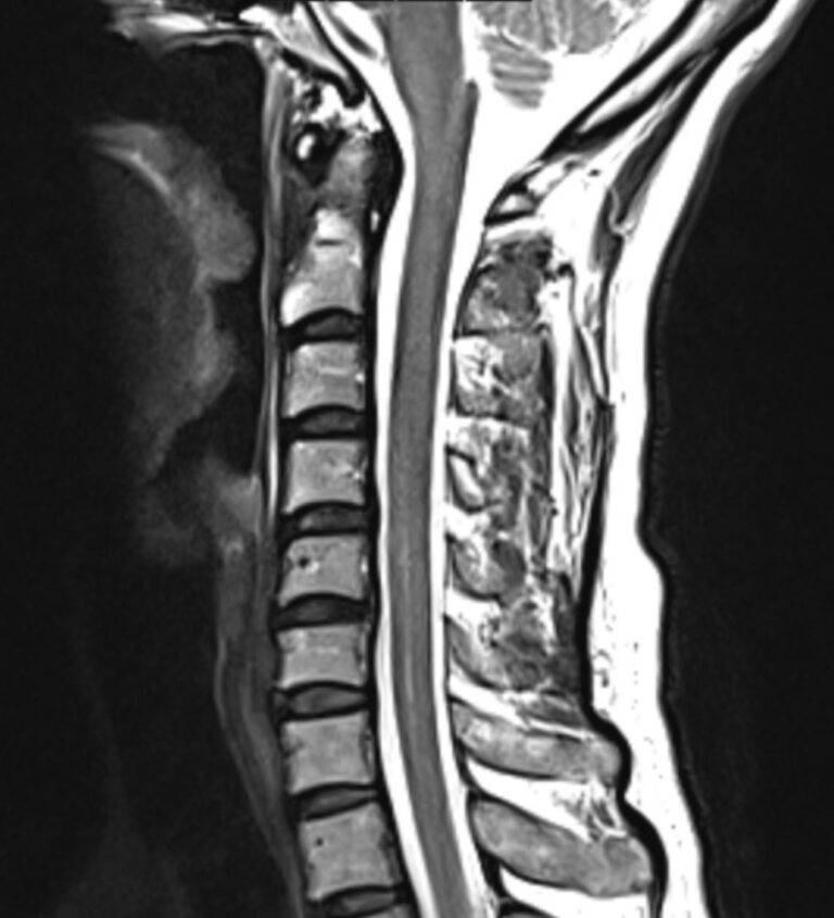 MRT HWS (Halswirbelsäule)
