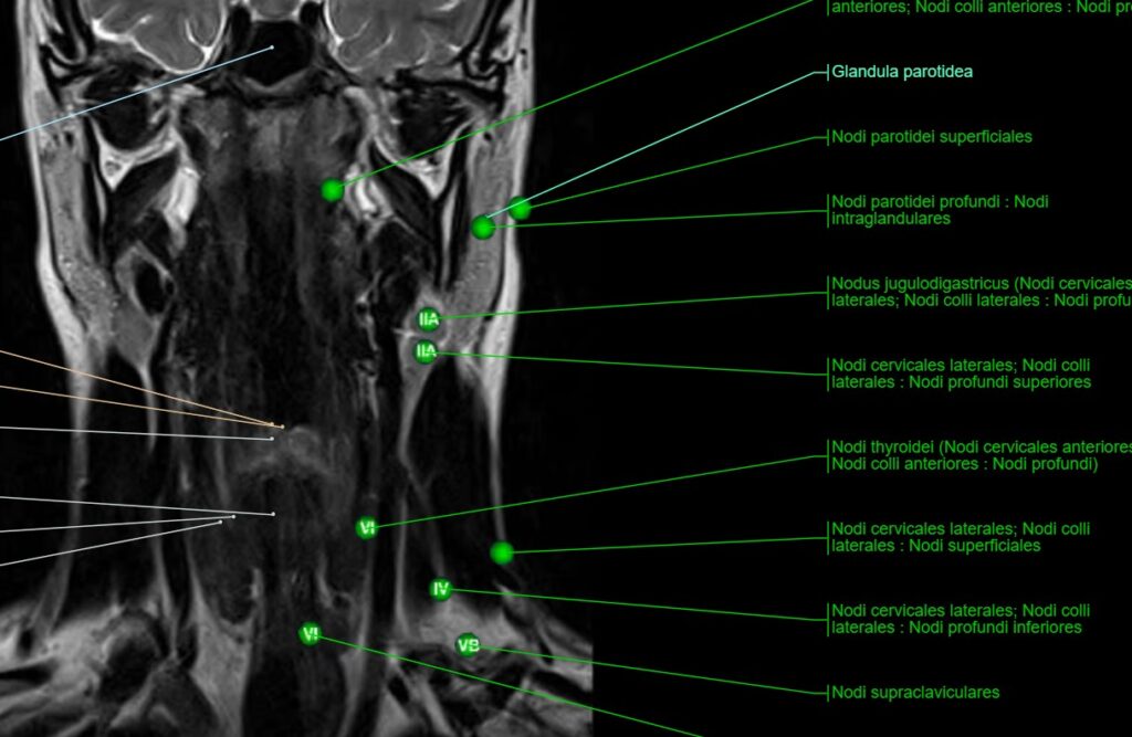 Geschwollene Lymphknoten - was steckt dahinter?