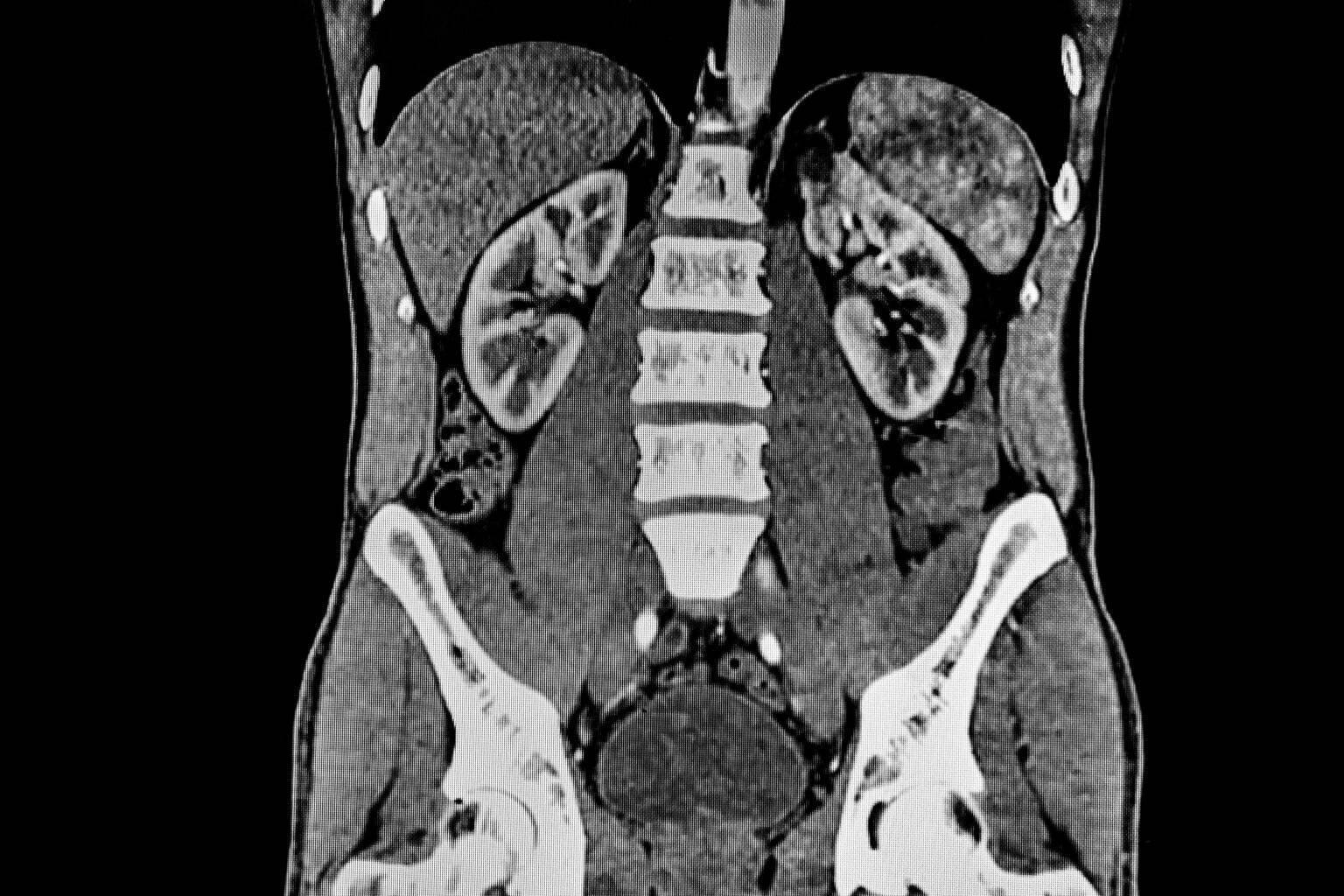 Computed Tomography Scan Of Chest Abdomen And Pelvis
