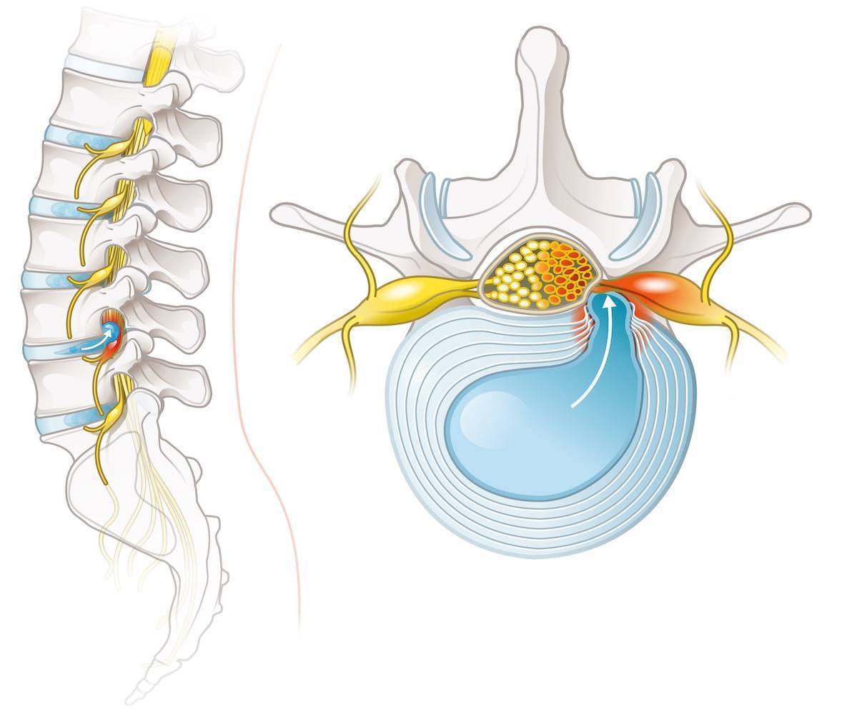 Bandscheibenvorfall HWS (Halswirbelsäule) | medneo.com
