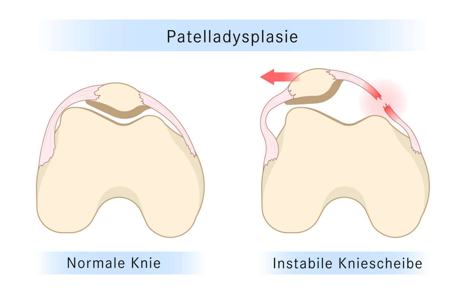 Patelladysplasie: Behandlung und Therapie | medneo.com