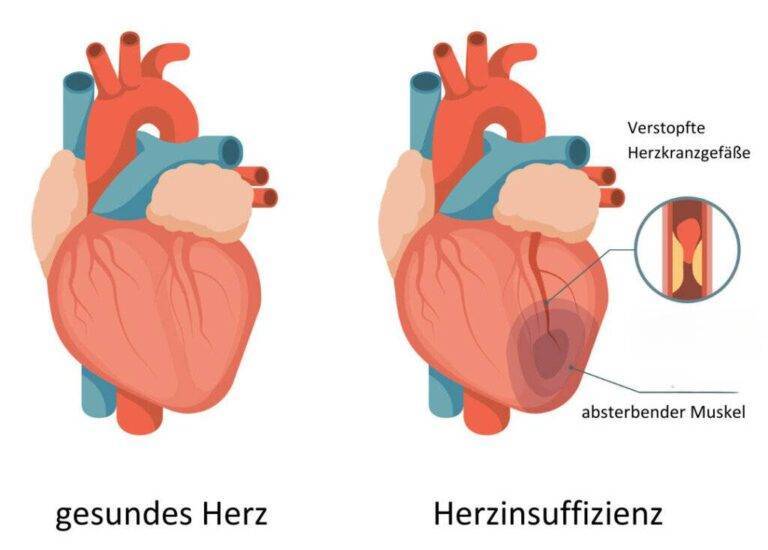Herzinsuffizienz: Symptome und Behandlung